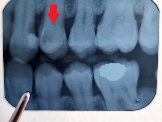 Edmonton woman awarded more than £6,000 after dentist drilled too ...