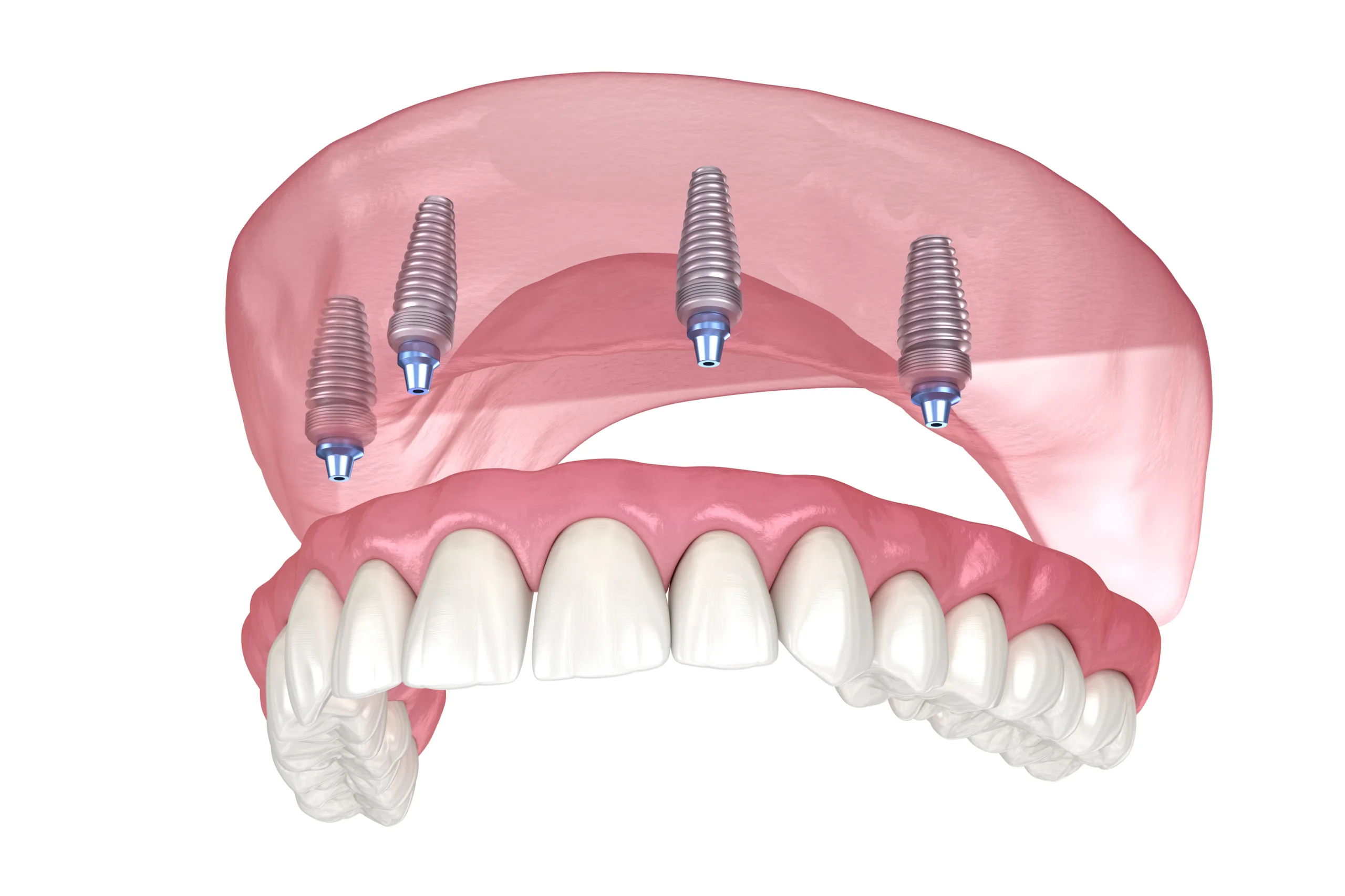 Fix severe upper jawbone issues with zygomatic implants