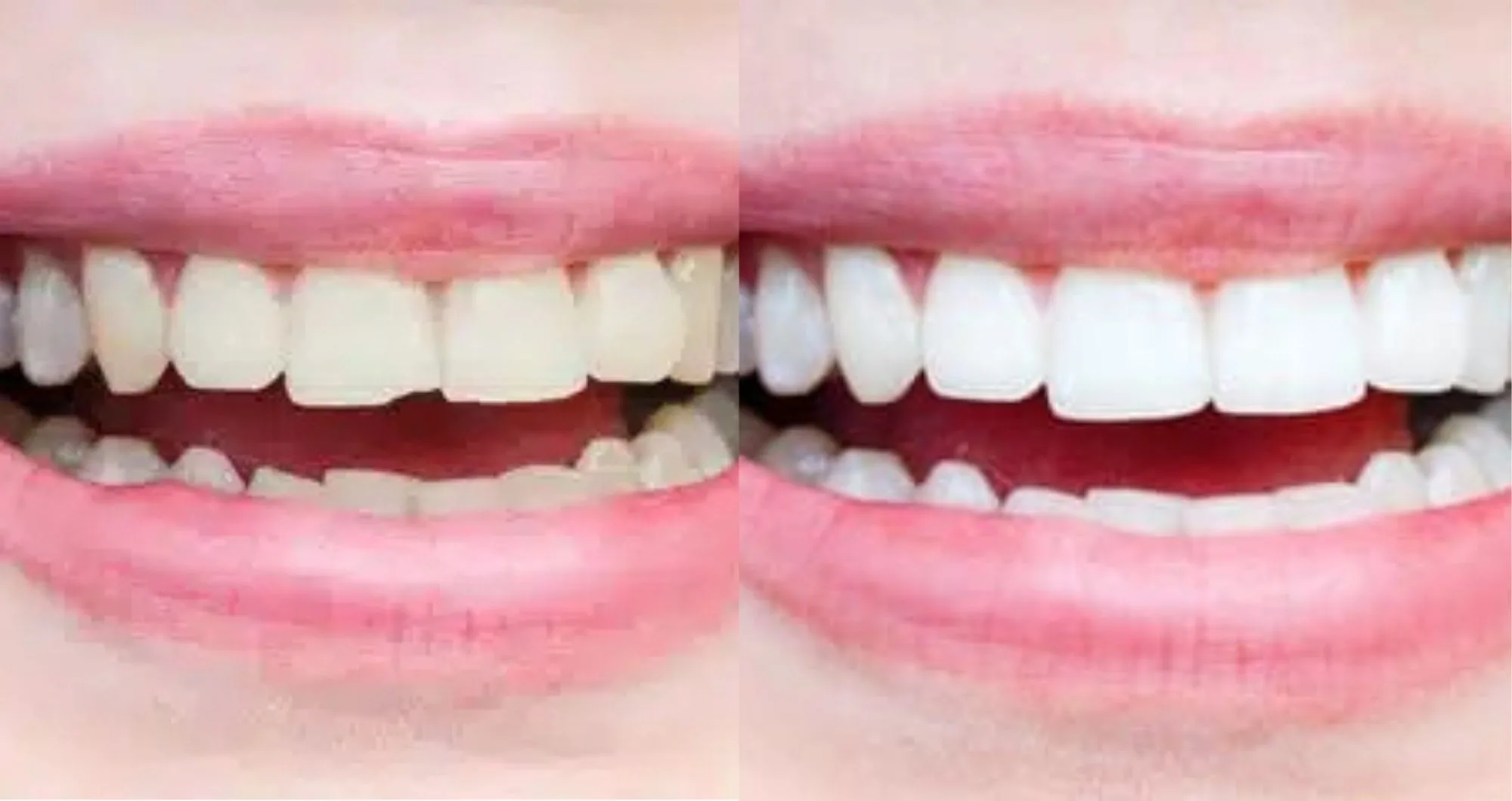Fill gaps between teeth with composite bonding