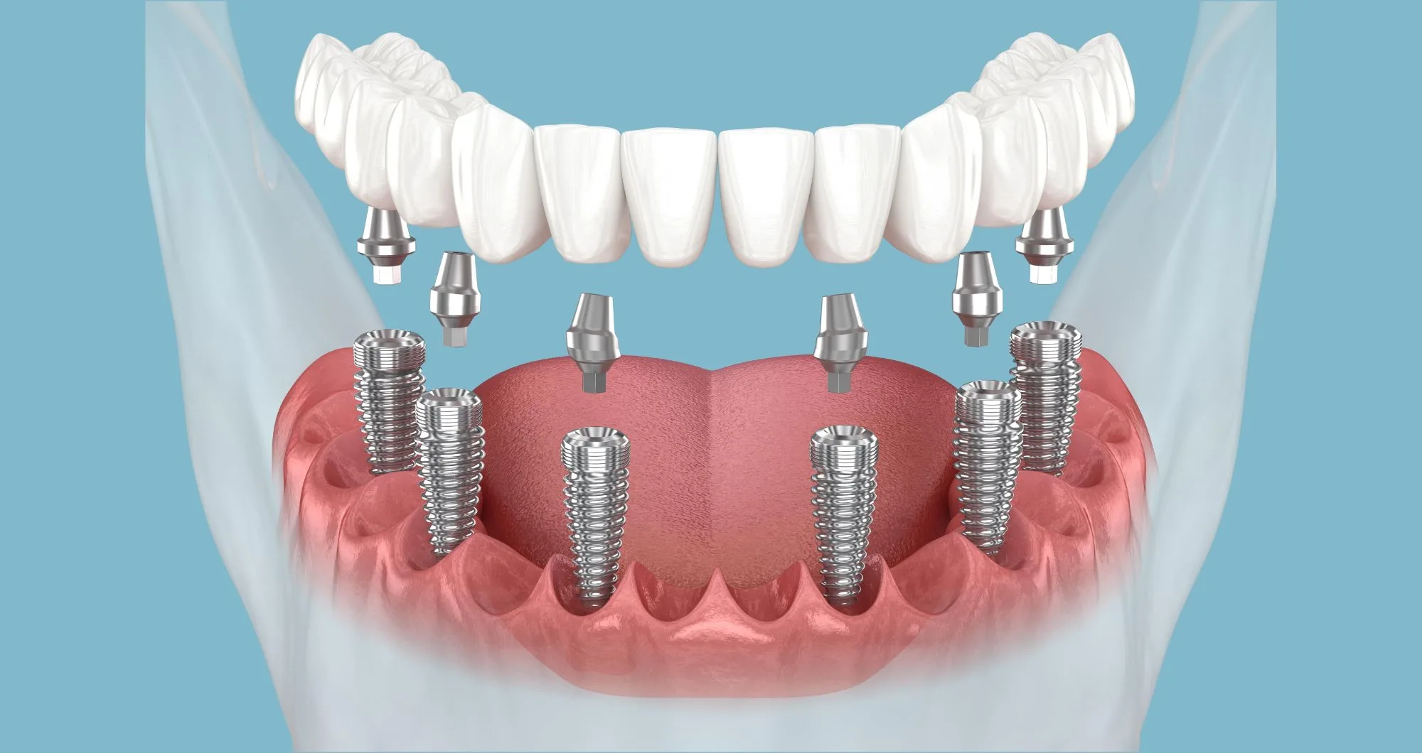 Restore your oral functions with All-On-4 implants
