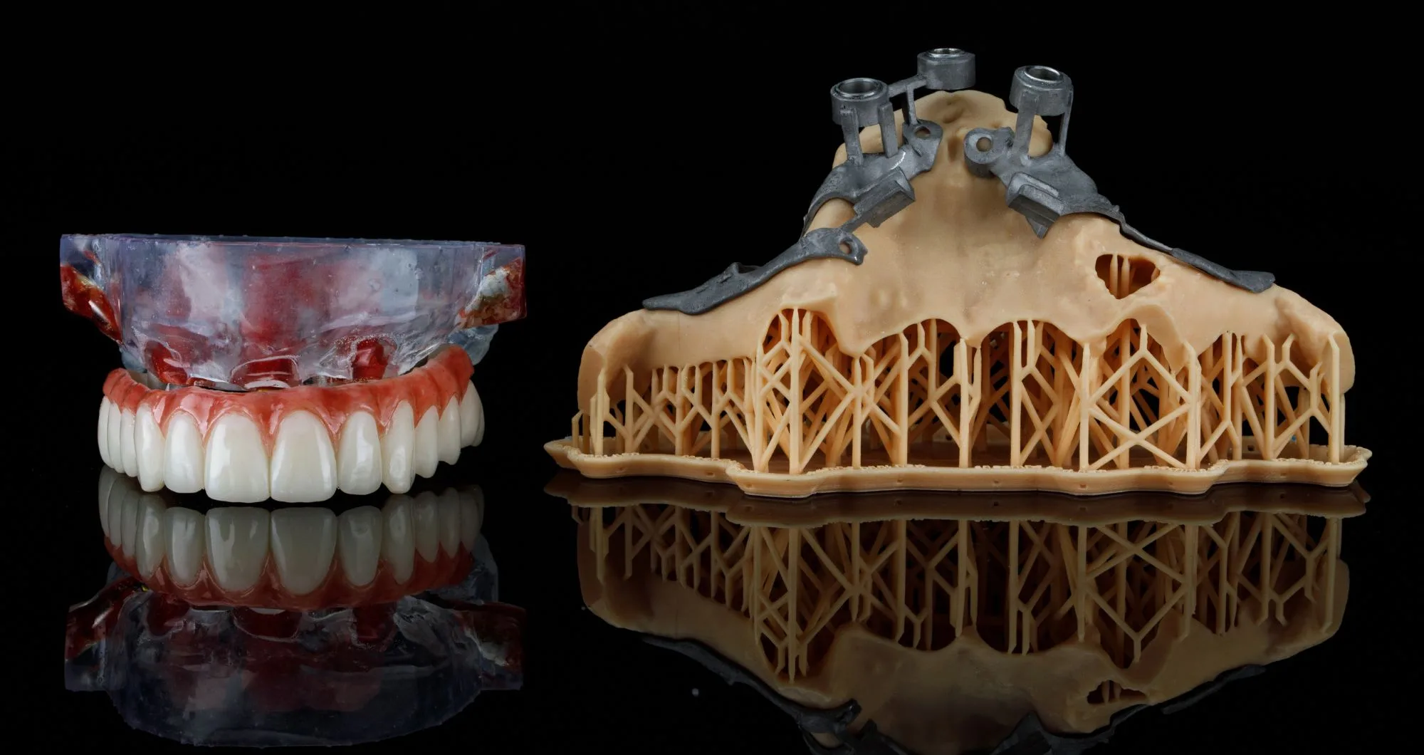 Replace missing teeth with subperiosteal implants