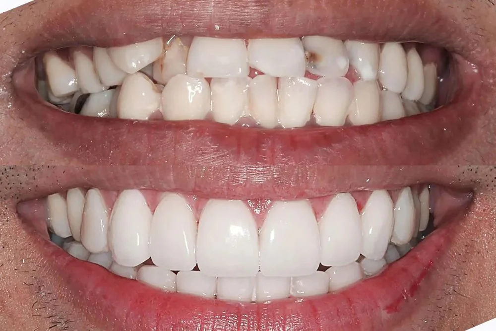 Fix crooked teeth with composite bonding
