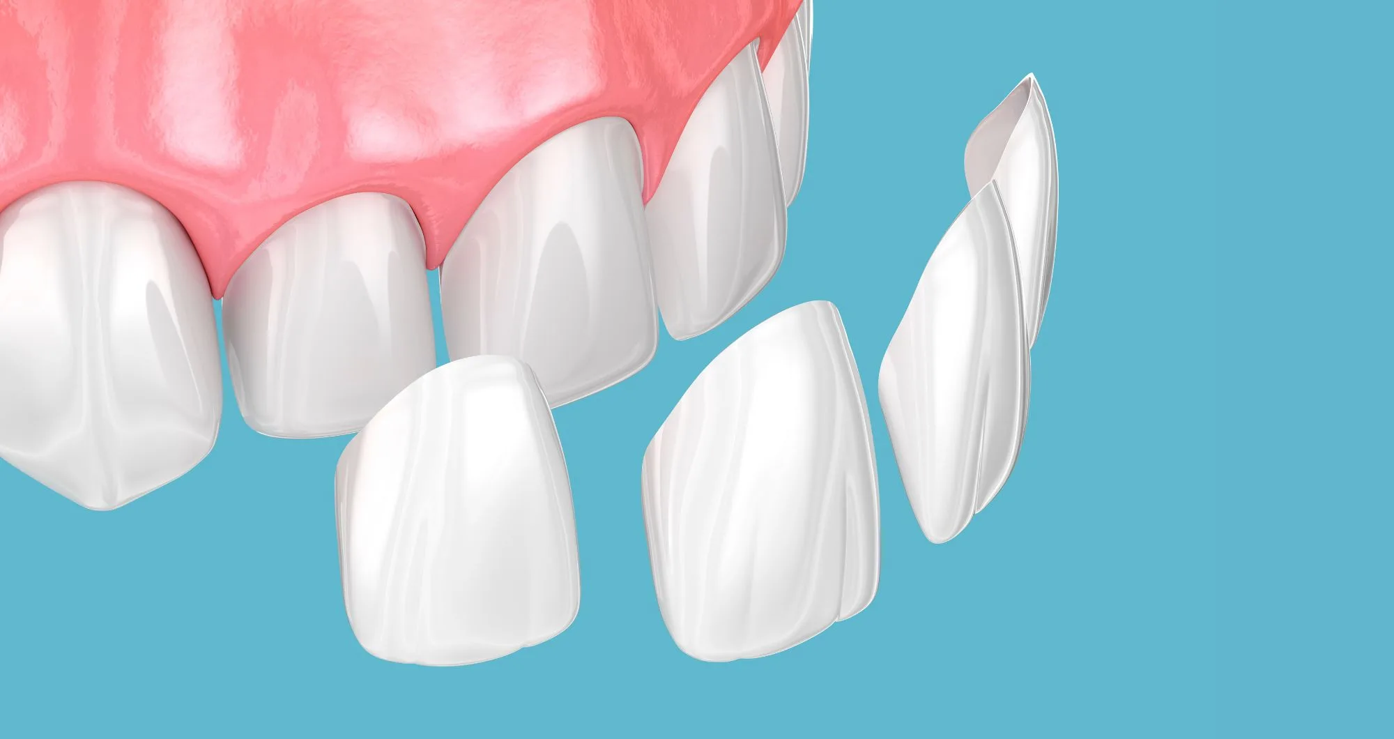 Fix crooked teeth with composite bonding