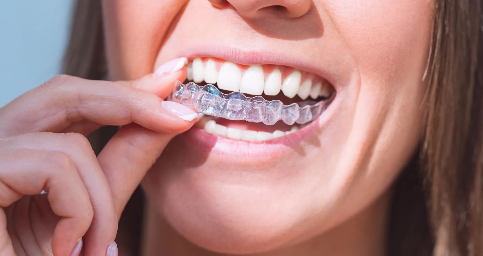Treat dental issues with different Invisalign options