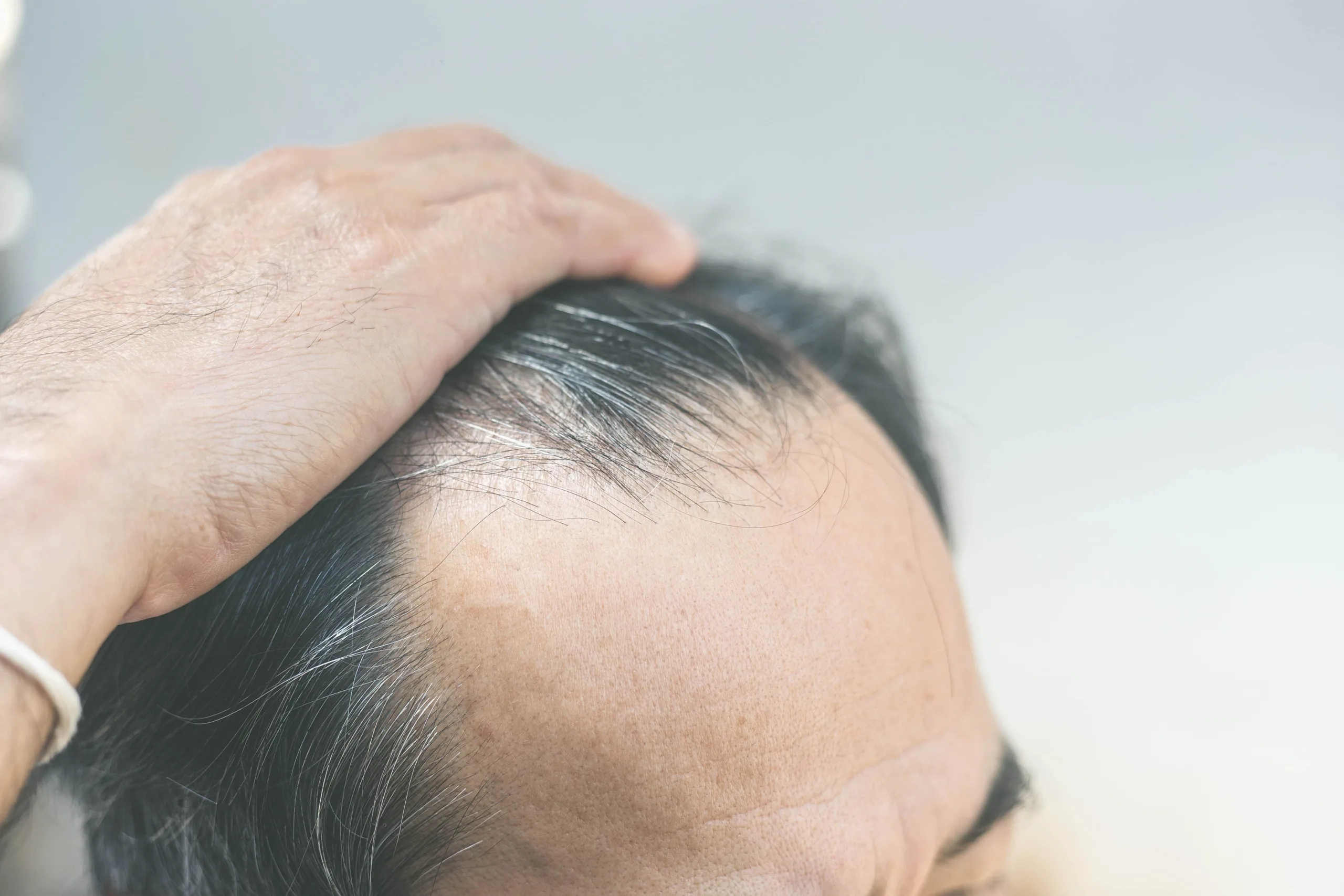 Does Creatine Cause Hair Loss? Men's Regrowth Guide