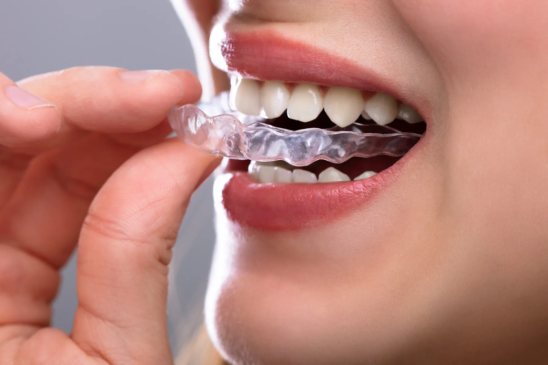 Aligners for crowding and gaps: A clear path to a healthier smile ...