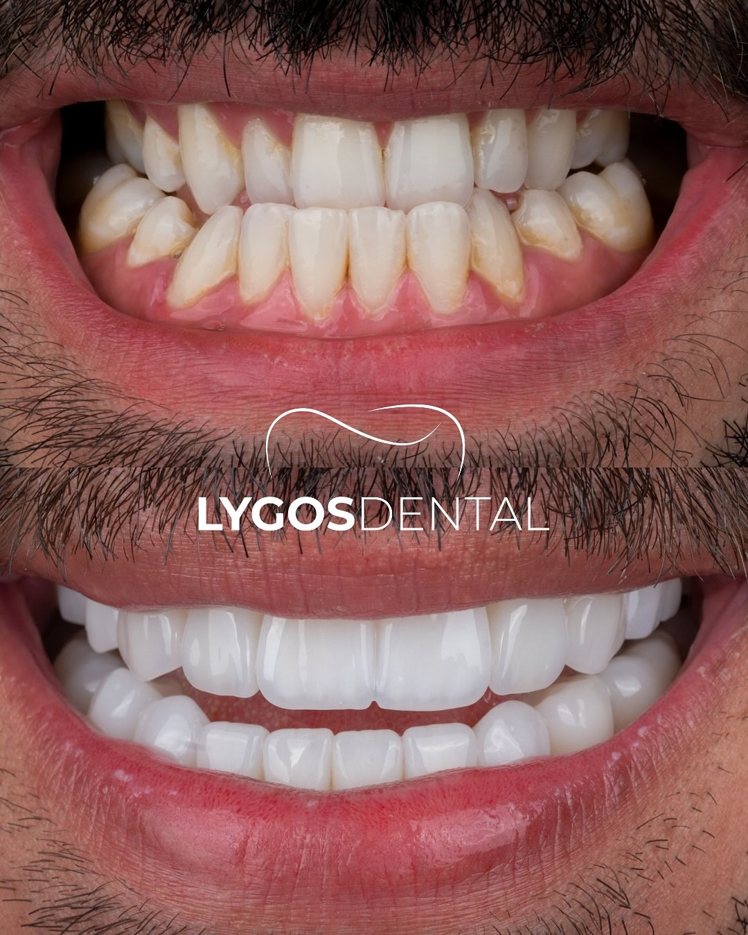 Emax vs Zirconia: Which Dental Veneer Is Better for Your Smile?