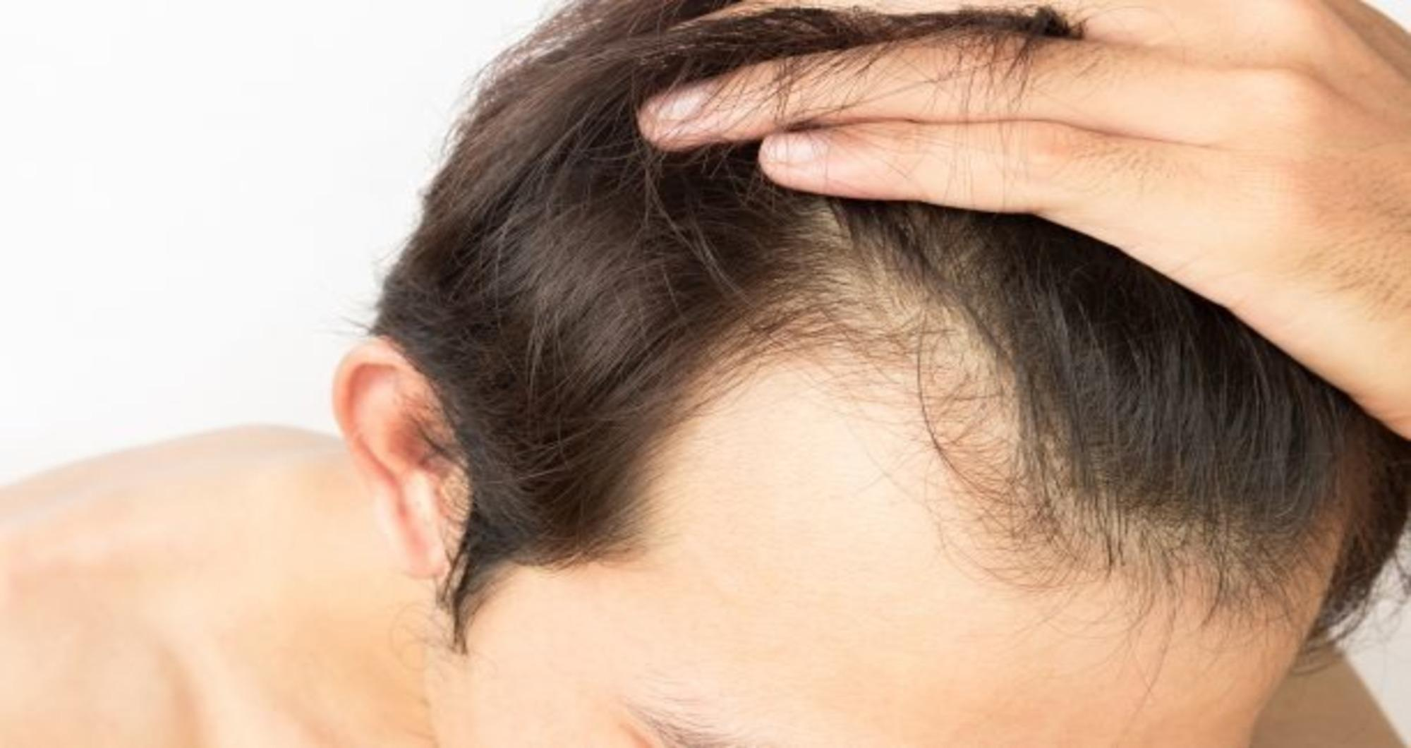 Fighting Hair Loss in Style: Understanding PRP Hair Restoration in the UK